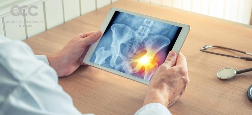 Hip Pain Denver | Hip Surgeon | Denver, Colorado